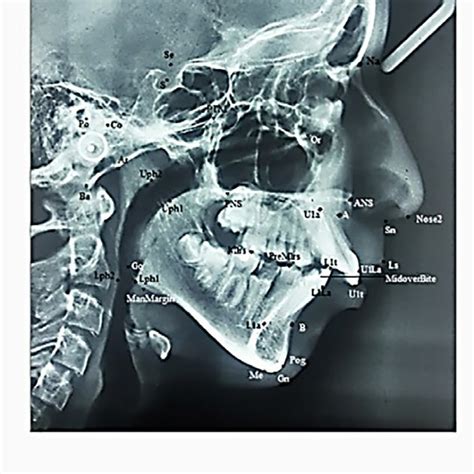The Cephalometric Analysis Screen Download Scientific Diagram