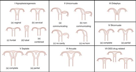 Müllerian Uterine Anomalies Radiology Key