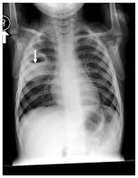 Lung Abscess Symptoms Types Causes Diagnosis