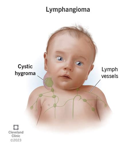 Lymphangioma Neck