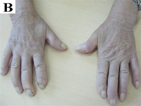 Medicina Aps ¿artritis O Artrosis