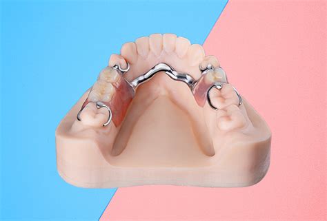 Precision Metal Dentures Istar Dental Lab
