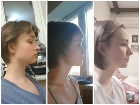 Mewing Before After Results 70 Crazy Transformations