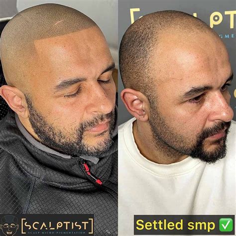 Scalp Micropigmentation Everything You Need To Know About It Artofit