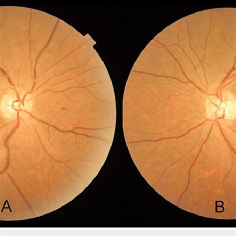 Fundus Photograph A Fundus Photograph Of The Right Eye Showing Mild
