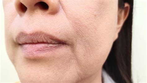 The Flabby Wrinkled And Sagging Beside The Cheeks Stock Image Image