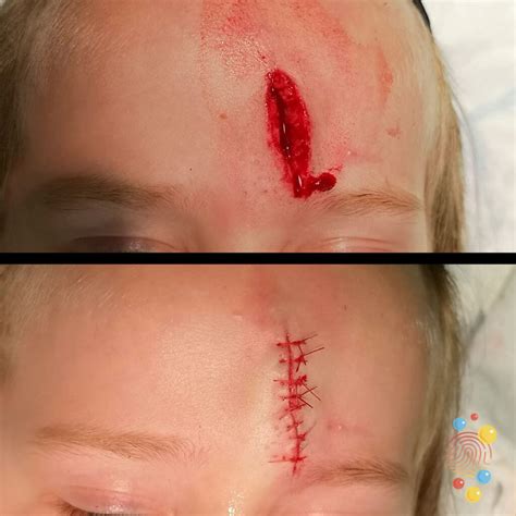 Lacerations Skin Deep