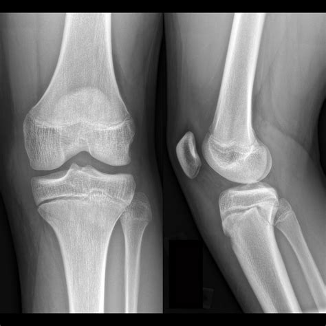 Pediatric Tibial Plateau Fracture Pediatric Radiology Reference