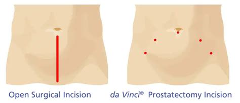 Prostatectomy Simple Or Radical Associated Urological Specialists