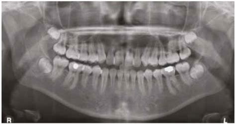 Orthodontic Update Generalized Severe Idiopathic External Root Resorption And The Importance
