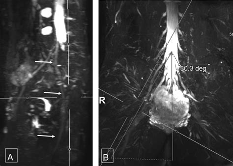 Lumbar Plexus Mri