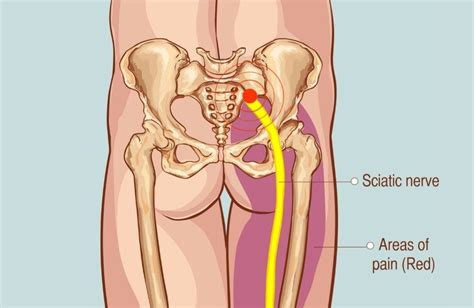 The 5 Best Exercises To Get Rid Of Sciatica Pain In The Hip And Lower Back