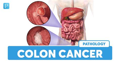 Colon Cancer Symptoms Clinical Features And Treatment🍽 Aproveite As