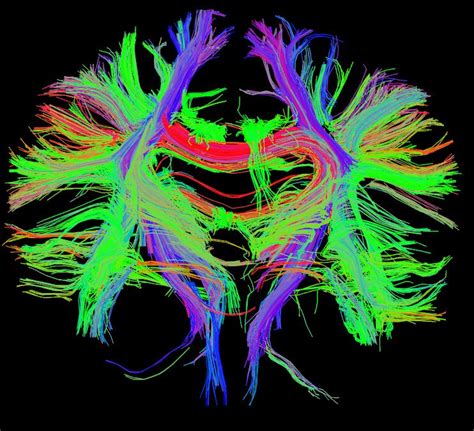 Corpus Callosum Imaging Tom Gillette