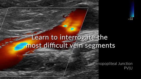 For Ultrasound Students Learn How To Perform Venous Reflux Studies