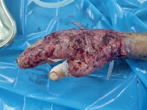 Pyoderma Gangrenosum Of The Hand Unique Experience And Literature