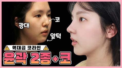 코성형vlog 여자친구 예린과 1초 신세경이 보이는👏 수민이의 후기 인터뷰💕코성형후기 코성형전후 윤곽수술후기 신세경코