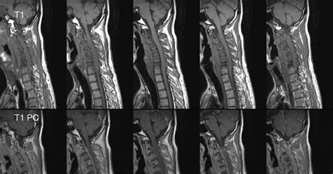 Neuroradiology Cases Vertebral Osteomyelitis Mri