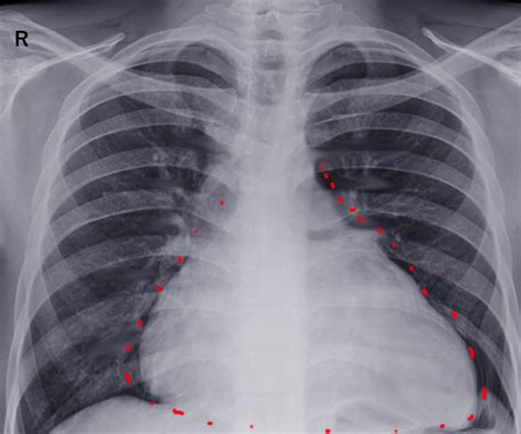 Figure Uremic Effusion Image Courtesy S Bhimji Md Statpearls