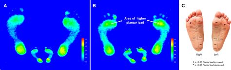 Plantar Load Distribution With Centers Of Gravity Balance And Rearfoot