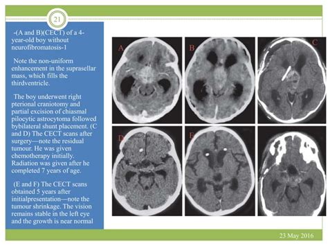 Optic Pathway Glioma Pptx