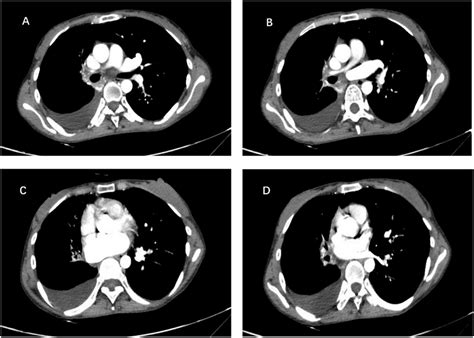 Contrast Enhanced Ct Showed That Soft Tissue Mass Like Lesions In Right