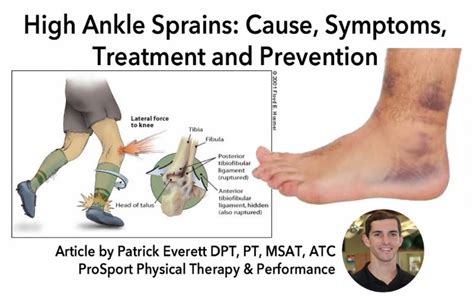 Sprained Ankle Signs Symptoms And Treatment