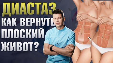 Диастаз прямых мышц живота Причины осложнения лечение Пластический