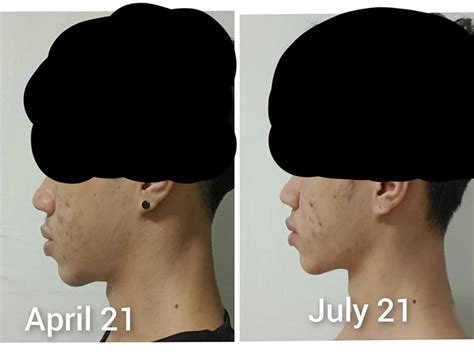 Mewing Before And After Results 70 Crazy Transformations