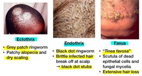 Tinea Capitis Ectothrix
