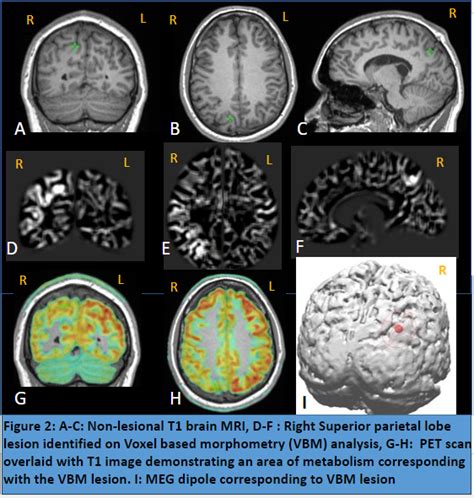 Understanding Epilepsy Networks And Rapid White Matter Propagation Of Epileptogenicity Through