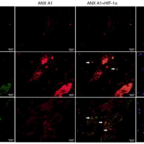 Detection Of The Localization Of Hif 1α And Anx A1 Expression In