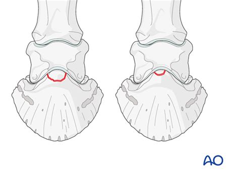 Distal Phalanx Extensor Process Fractures