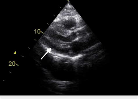 Echocardiography Shows Pericardial Effusion White Arrow Download