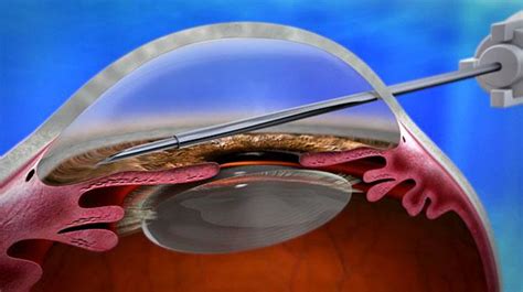 Glaucoma Symptoms Diagnosis And Treatment Capitol Eye Care