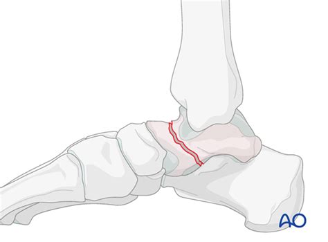 Anteromedial Approach To The Talus