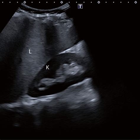 Us Attenuation Imaging In Mild Steatosis Score 1 8 Year Old Obese