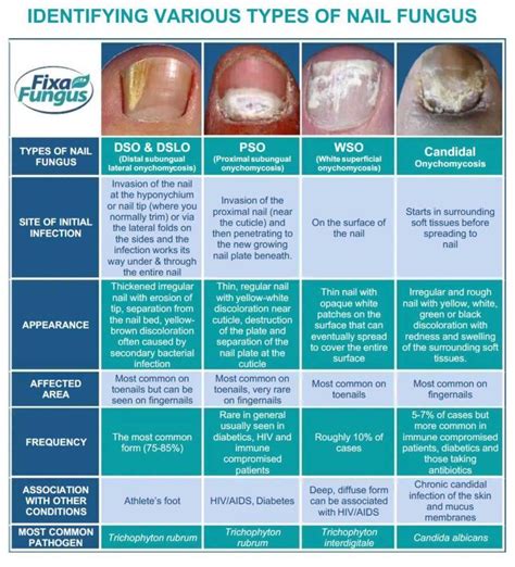 Toe Nail Fungus Types Infographic Horizon Foot Ankle Institute