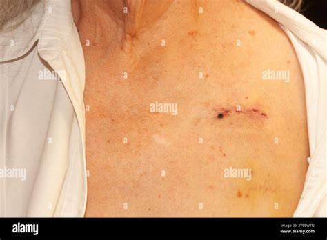 Post Surgical Scar On Elderly Persons Chest For Pacemaker Installation