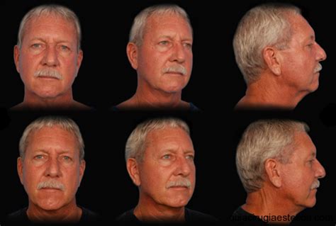 Lifting Facial para hombres explicado en casos de rejuvenecimiento facial Guía Cirugía Estética