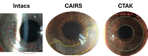 Corneal Tissue Addition The Science Behind The Procedure