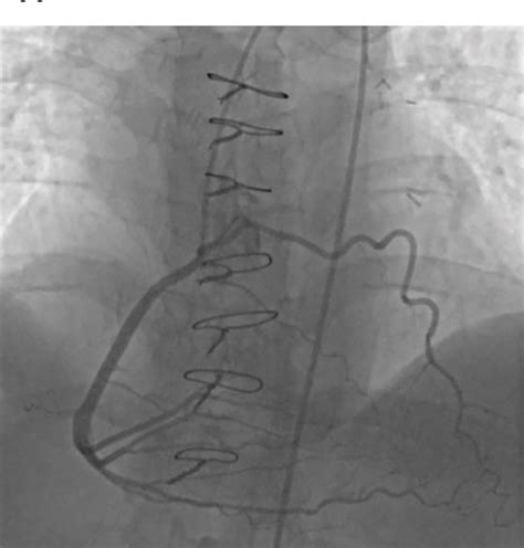 Structure Of Anterior Interventricular Sulcus Semantic Scholar
