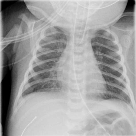 Newborn Sepsis With Apneas Em Sim Cases