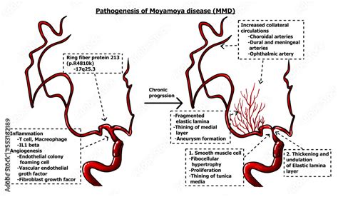 The Illustration Shown The Pathogenesis Of Moyamoya Disease With Progressive Steno Occlusive