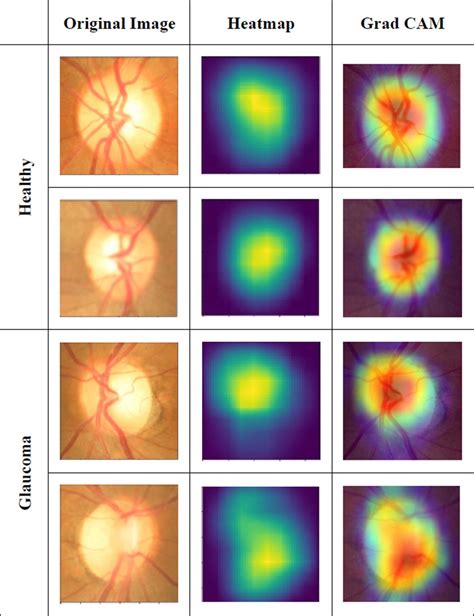 Image Based Glaucoma Classification Using Fundus Images And Deep Learning