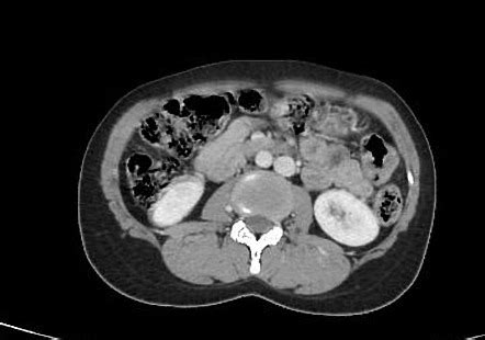 Left Sided Inferior Vena Cava Radiology Case Radiopaedia Org