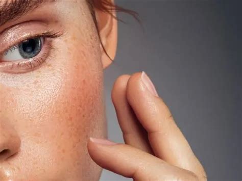 Macchie Sul Viso I Migliori Rimedi Per Schiarirle Efficacemente