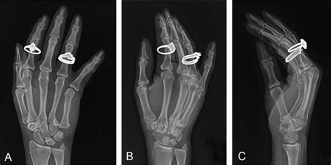 Metacarpophalangeal Joint Dislocation