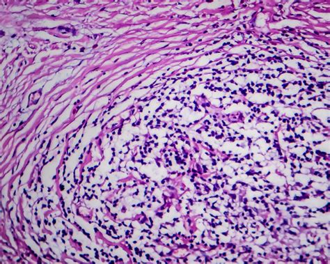 Difference Between Tag Archive For Sarcoidosis Sarcoidosis