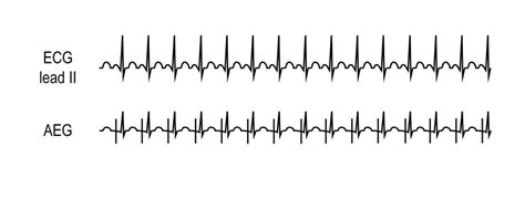 Sinus Tachycardia Atrial Electrogram Education Uwmadison